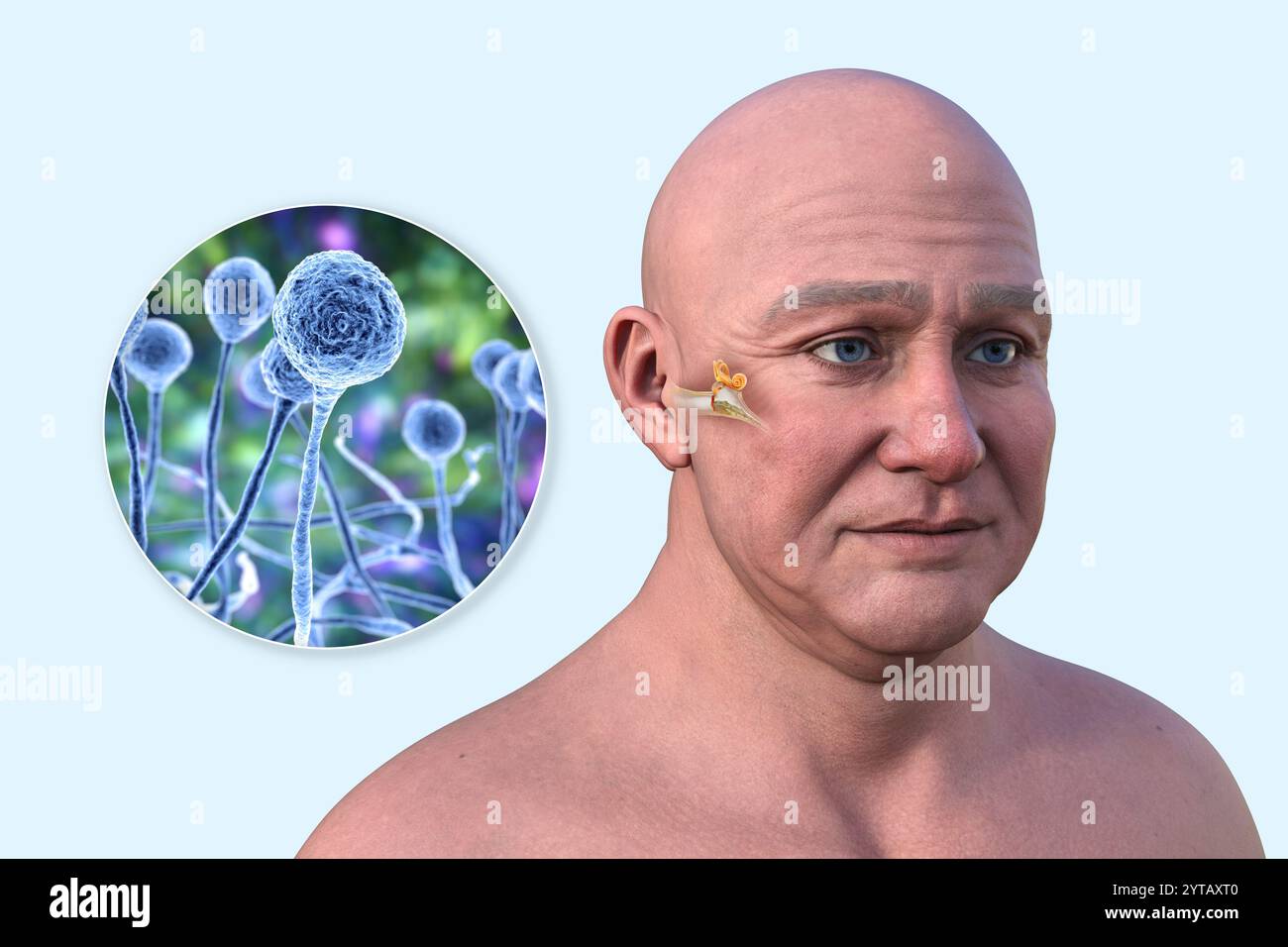 Computer illustration of a man with transparent skin showing fungal ...