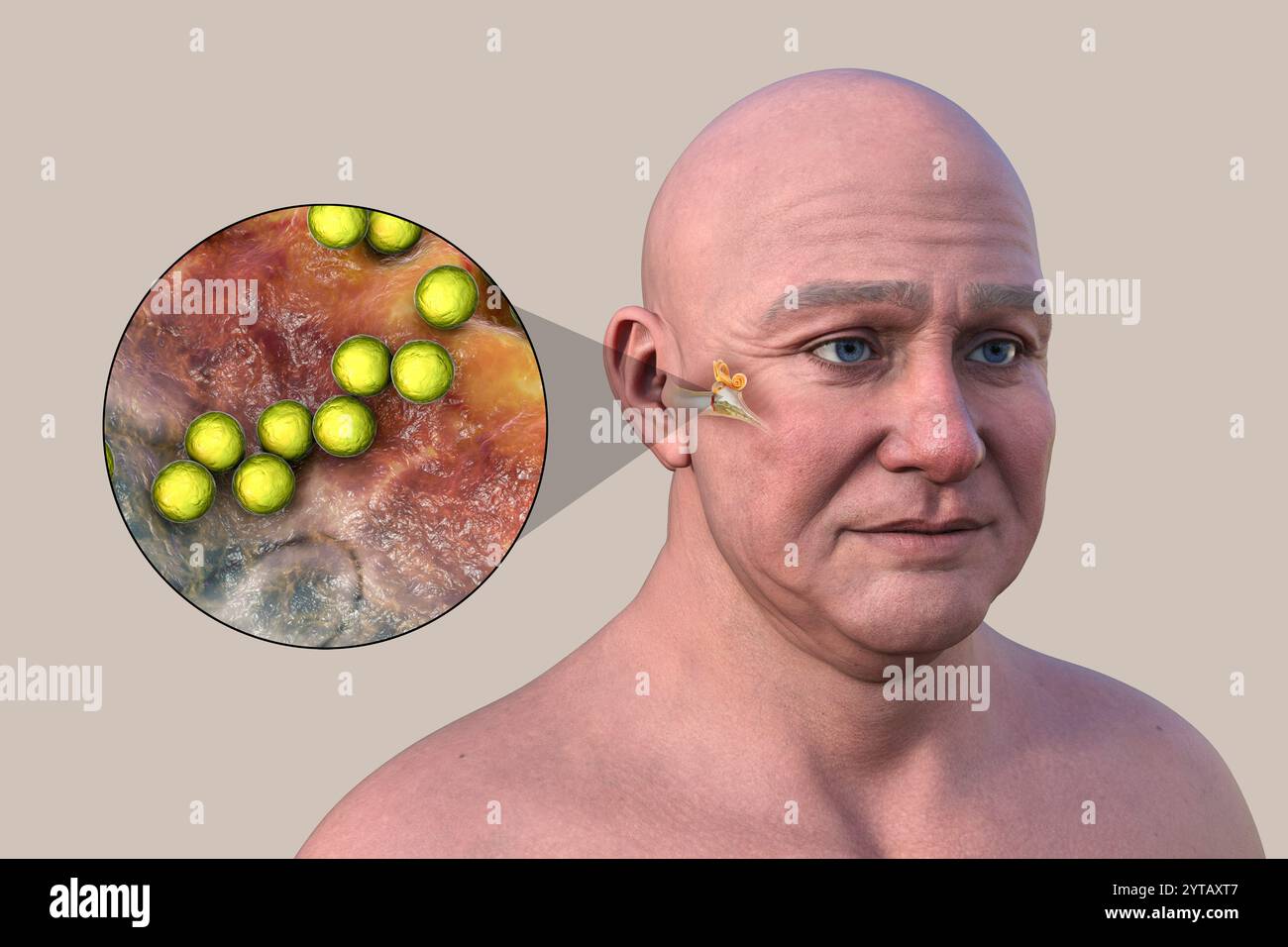 Computer illustration of a man with transparent skin revealing otitis ...