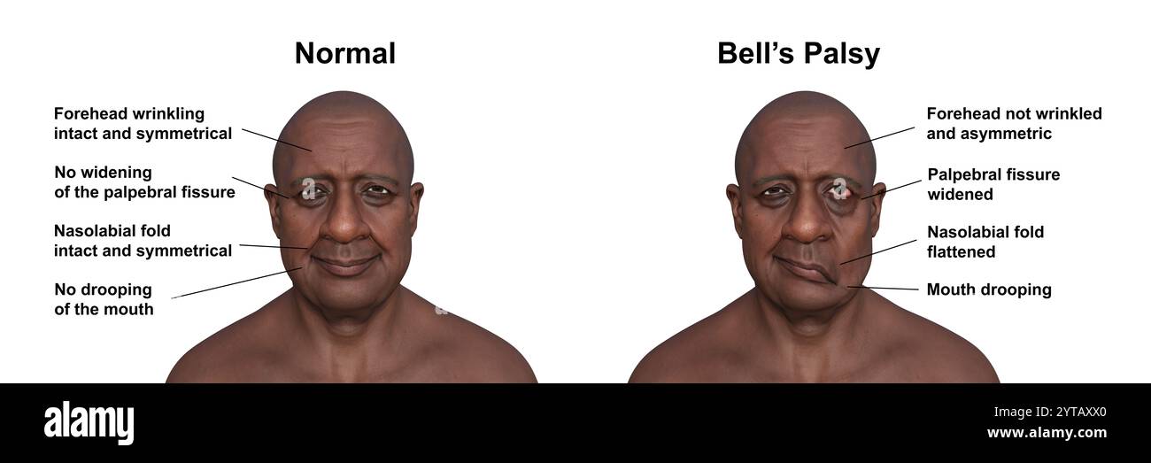 Facial palsy in a man, and the same healthy person. Computer ...