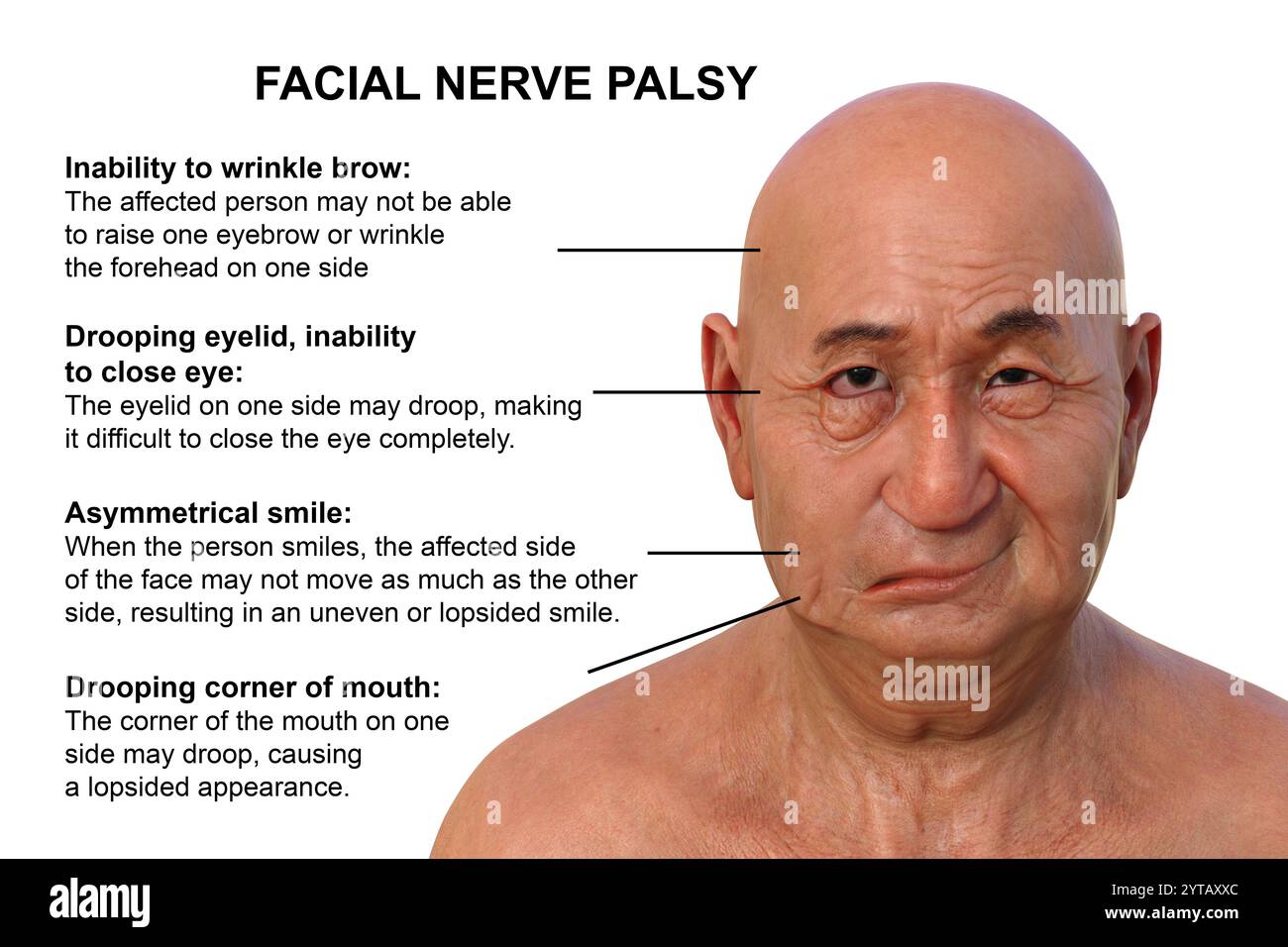 Facial palsy in a man. Computer illustration highlighting the asymmetry ...