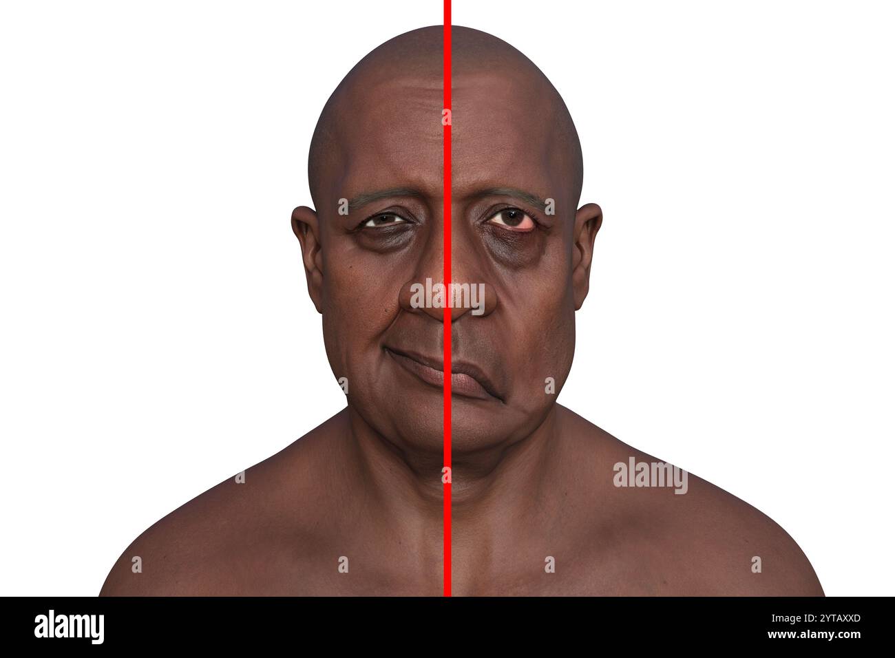 Facial palsy in a man. Computer illustration highlighting the asymmetry ...