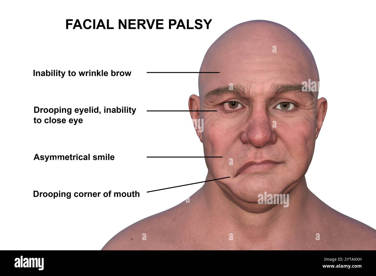 Facial palsy in a man. Computer illustration highlighting the asymmetry ...