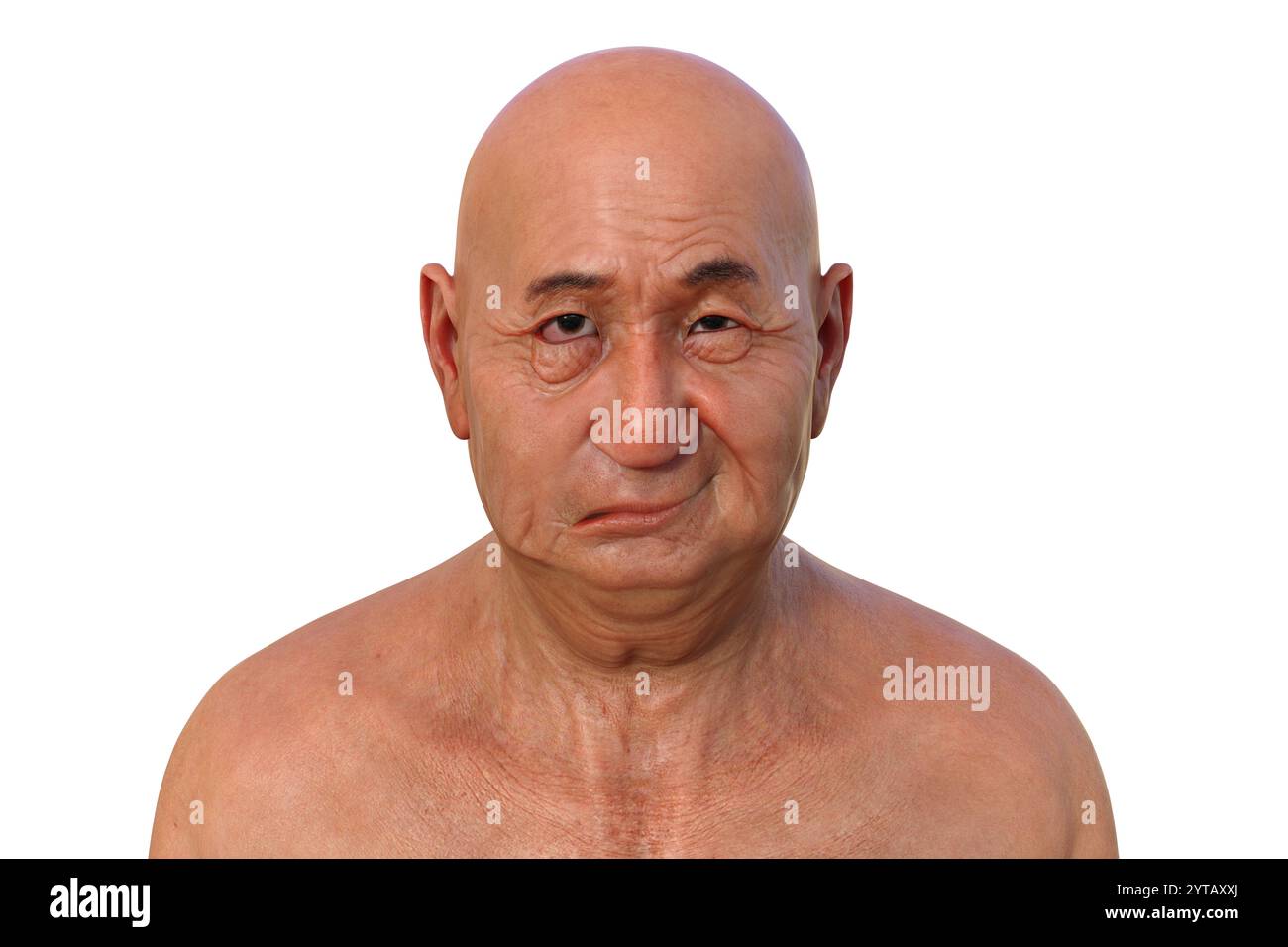 Facial palsy in a man. Computer illustration highlighting the asymmetry ...