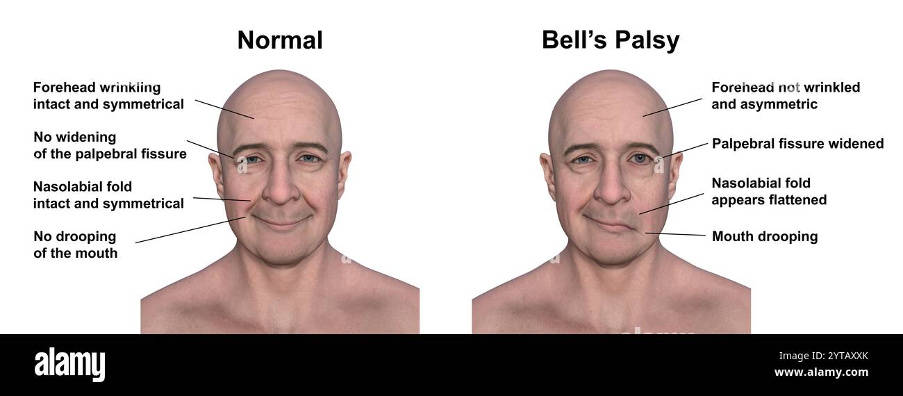 Facial palsy in a man, and the same healthy person. Computer ...