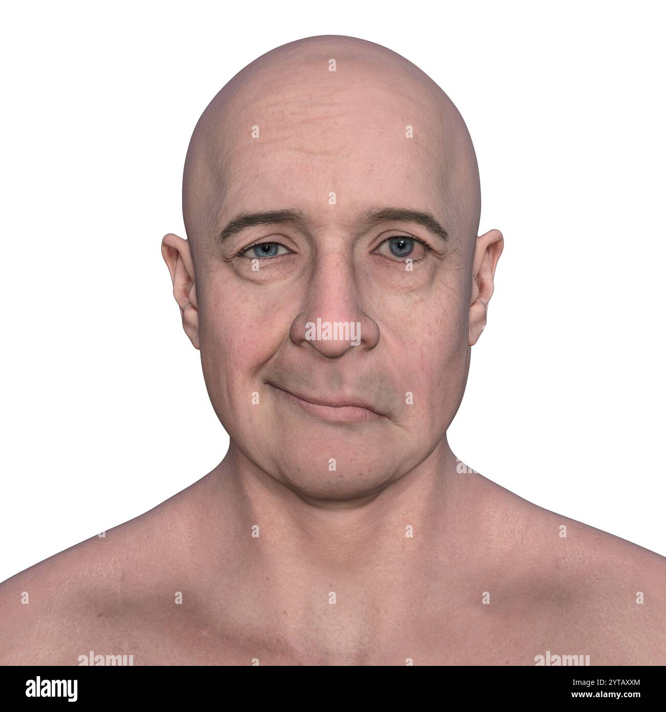 Facial palsy in a man. Computer illustration highlighting the asymmetry ...
