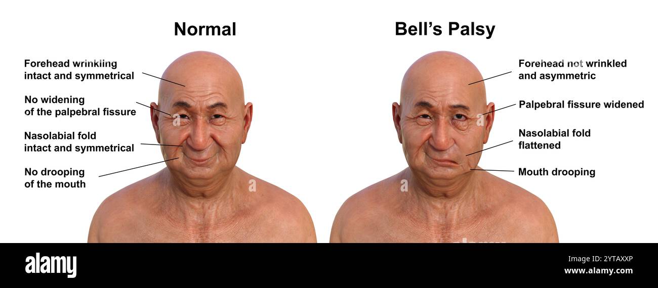 Bell's palsy hi-res stock photography and images - Alamy