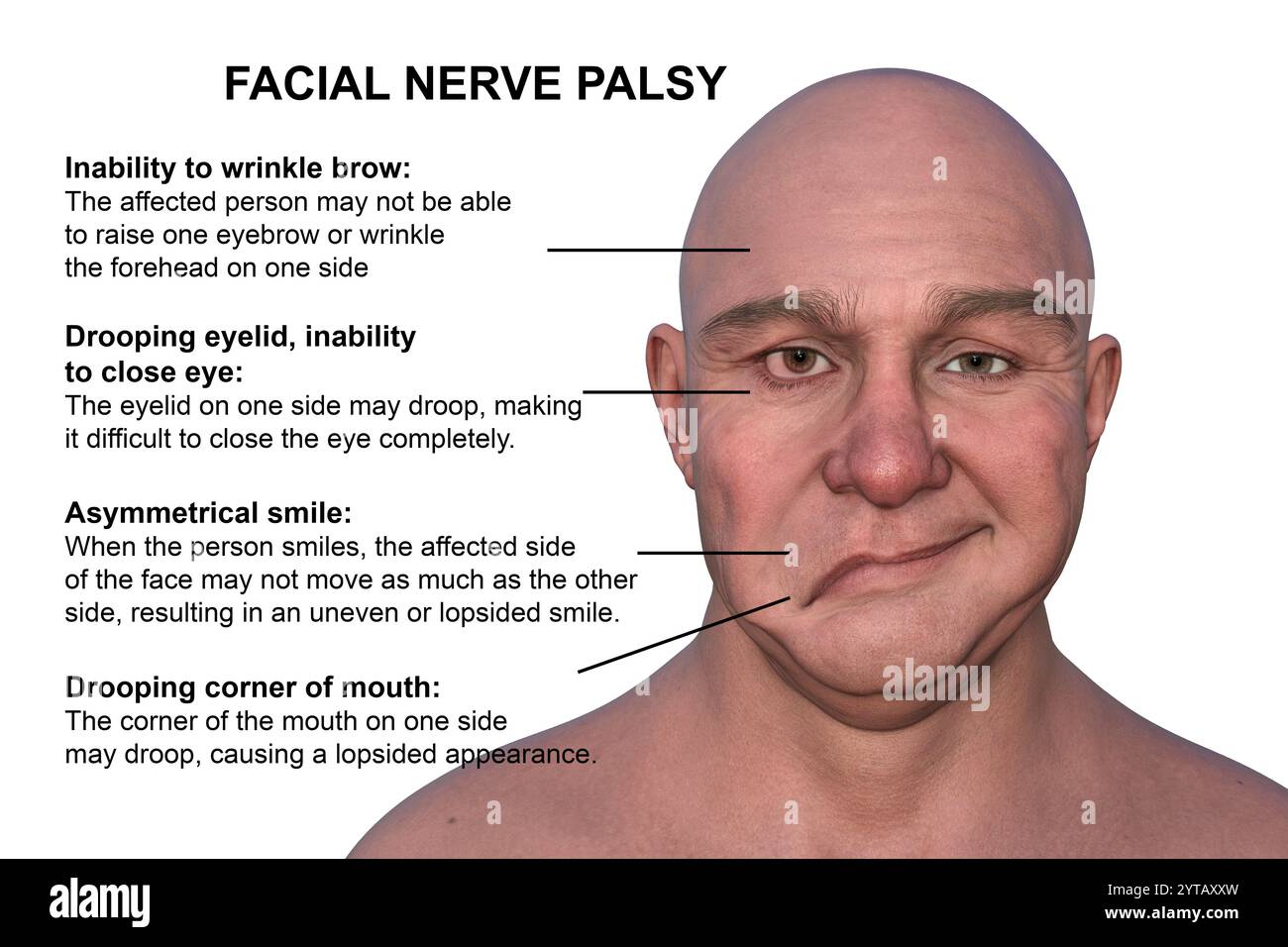 Facial palsy in a man. Computer illustration highlighting the asymmetry ...