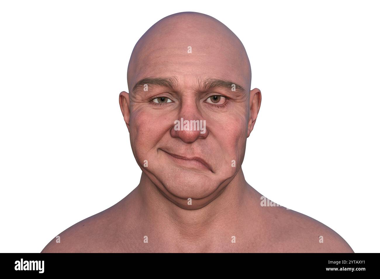 Facial palsy in a man. Computer illustration highlighting the asymmetry ...