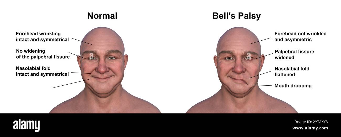 Facial palsy in a man, and the same healthy person. Computer ...