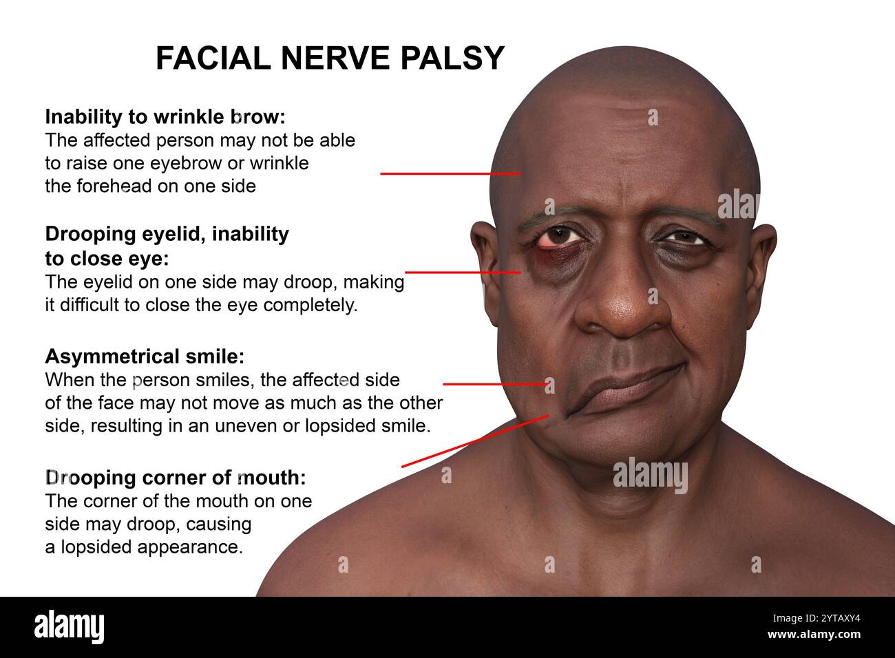 Facial palsy in a man. Computer illustration highlighting the asymmetry ...