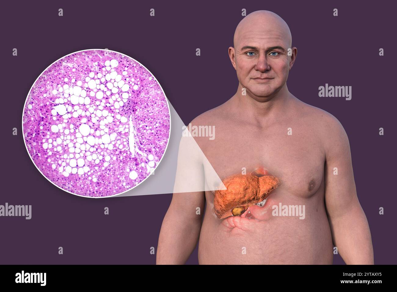 Computer illustration of a man with transparent skin, revealing a fatty ...