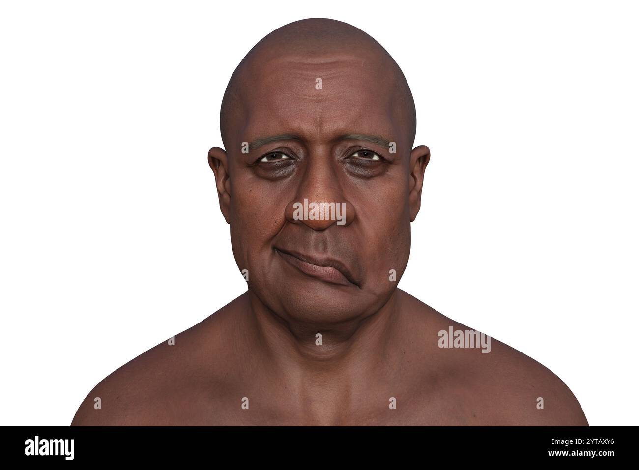 Computer illustration of a man showing left-side stroke, with drooping ...