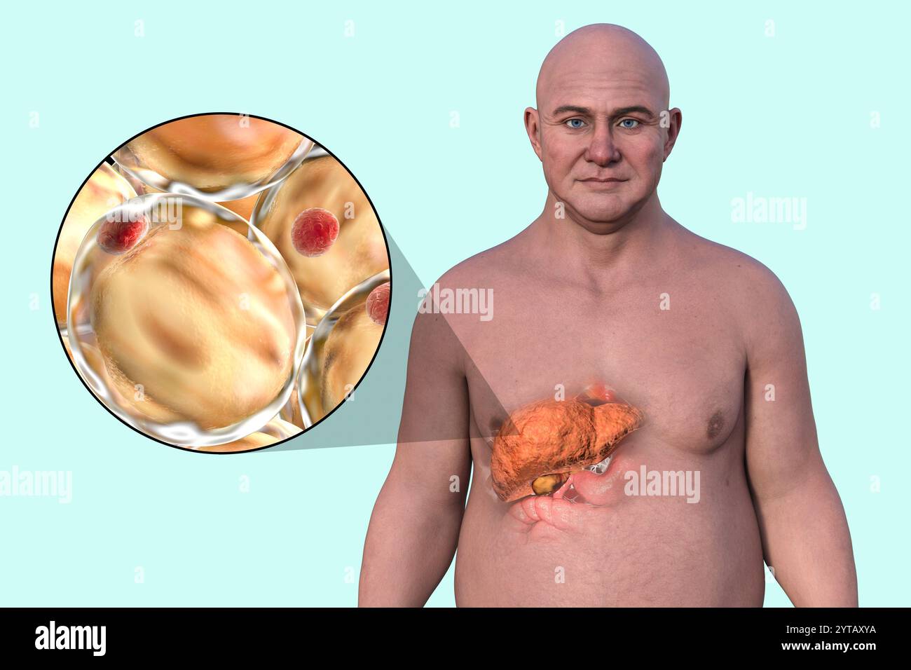 Computer illustration of a man with transparent skin, revealing a fatty ...