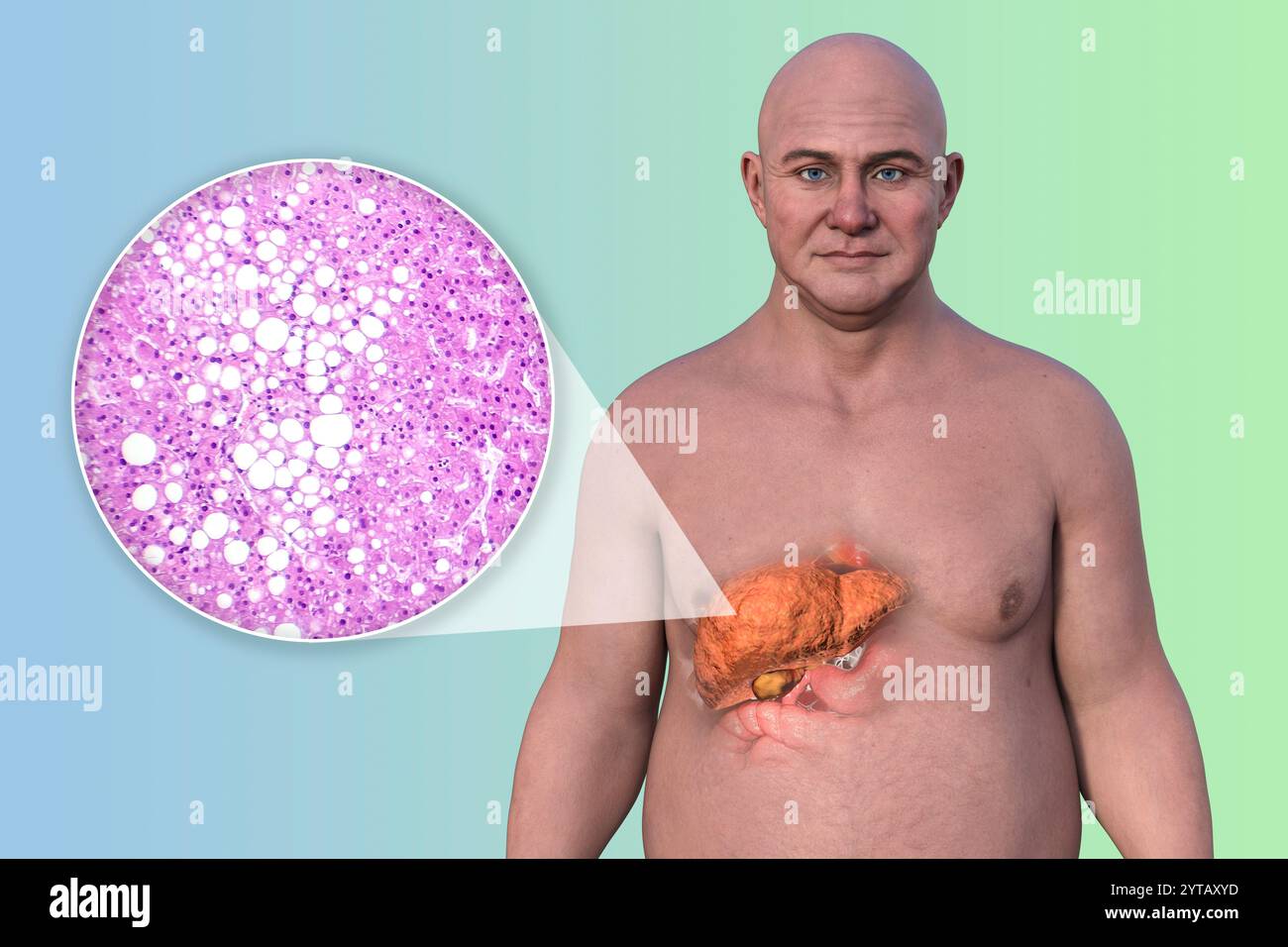 Computer illustration of a man with transparent skin, revealing a fatty ...