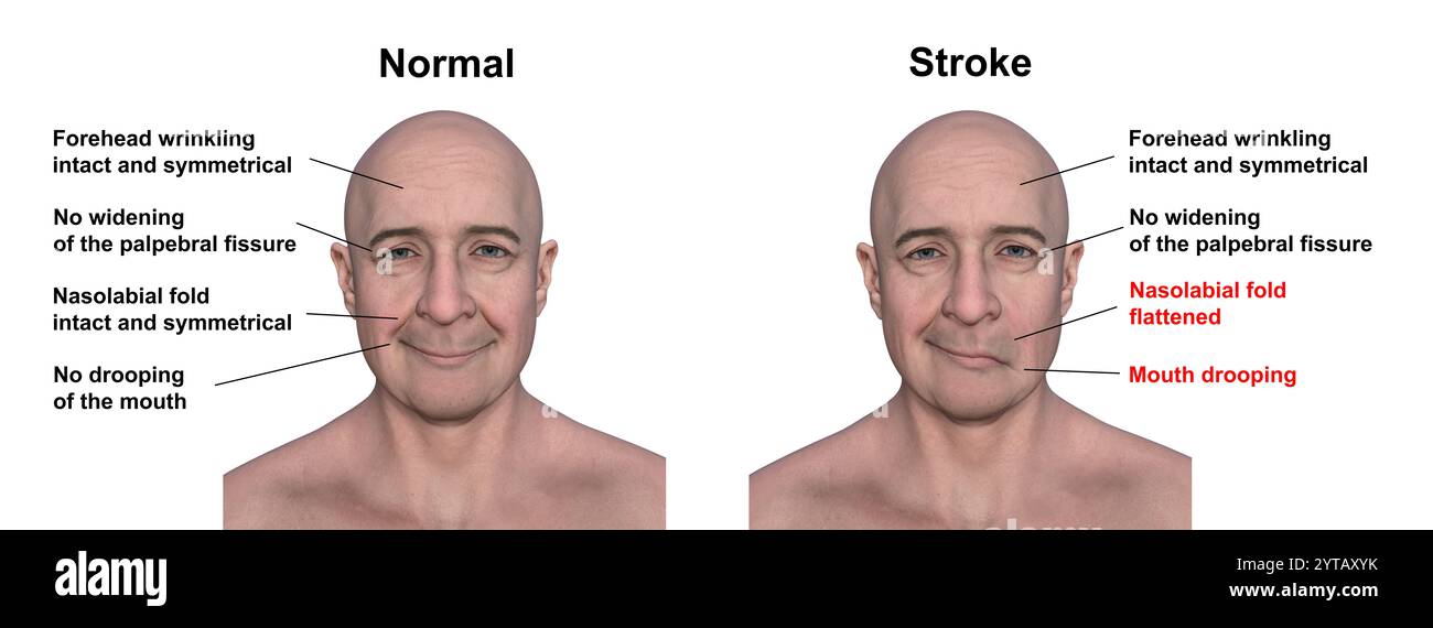Computer illustration of a man showing left-side stroke, with drooping ...