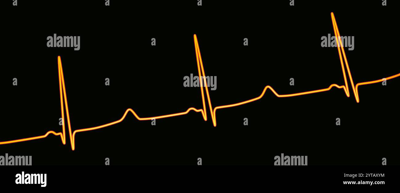 Illustration of an electrocardiogram (ECG) showing late onset T waves ...