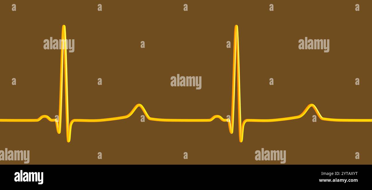 Illustration of an electrocardiogram (ECG) showing late onset T waves ...