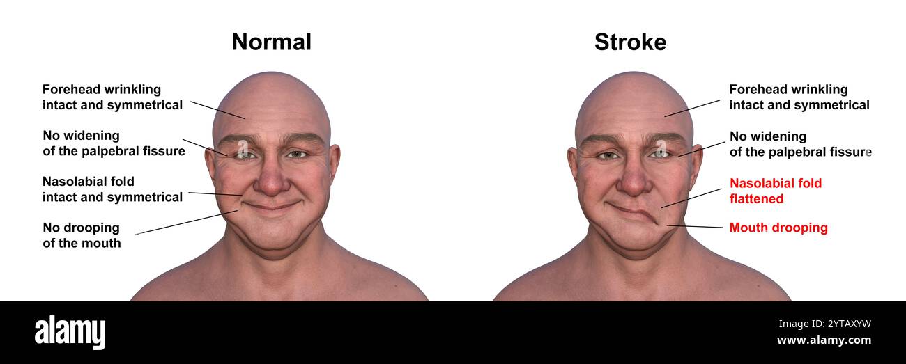 Computer illustration of a man showing left-side stroke, with drooping ...