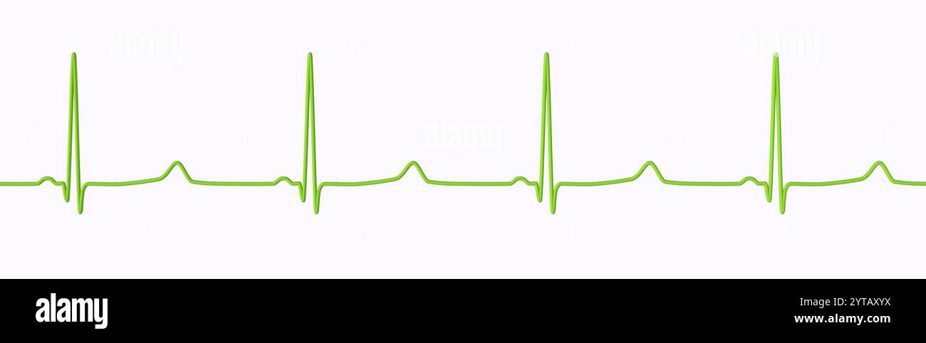 Illustration of an electrocardiogram (ECG) showing late onset T waves ...