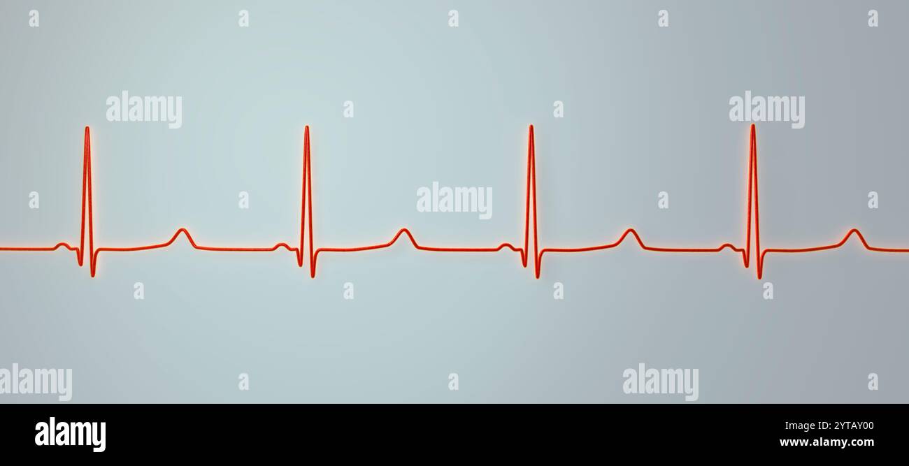 Illustration of an electrocardiogram (ECG) showing late onset T waves ...
