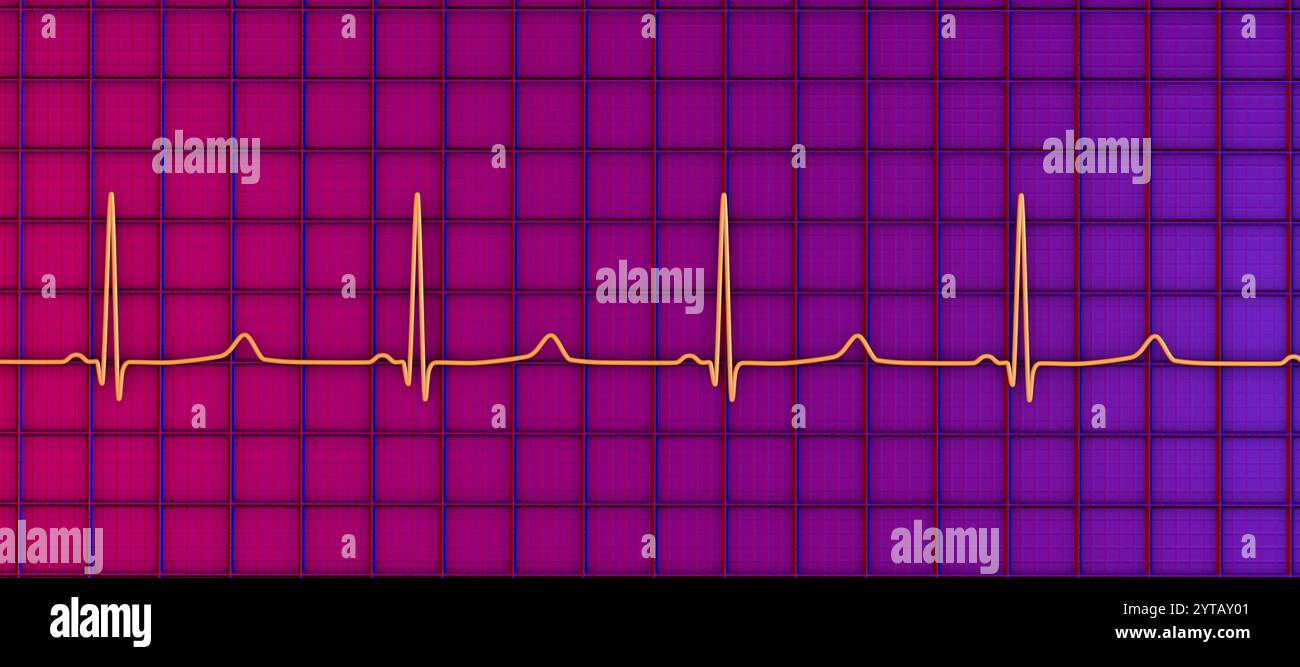 Illustration of an electrocardiogram (ECG) showing late onset T waves ...
