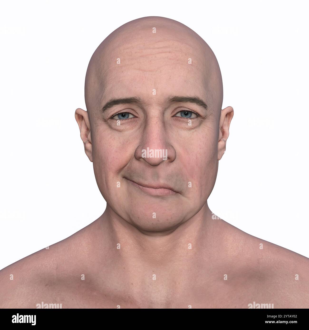 Facial paralysis stroke hi-res stock photography and images - Alamy