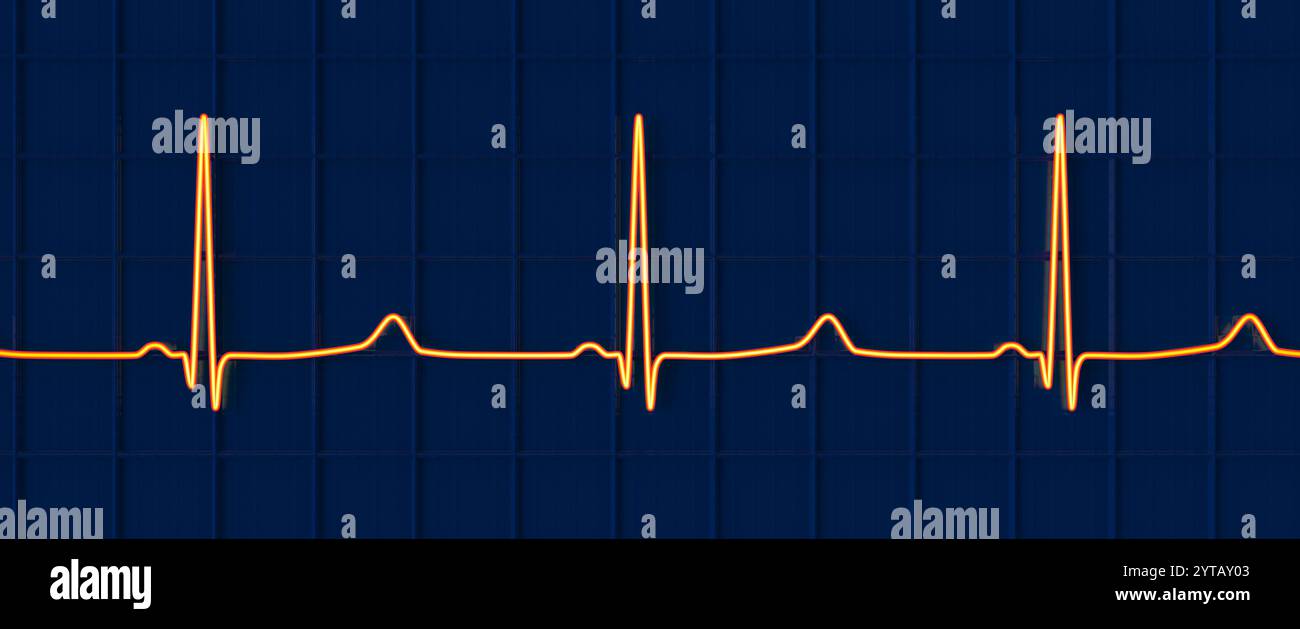 Illustration of an electrocardiogram (ECG) showing late onset T waves ...
