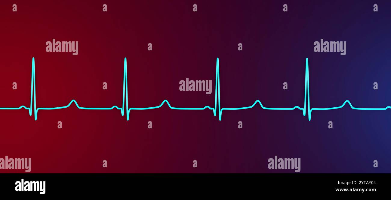 Illustration of an electrocardiogram (ECG) showing late onset T waves ...