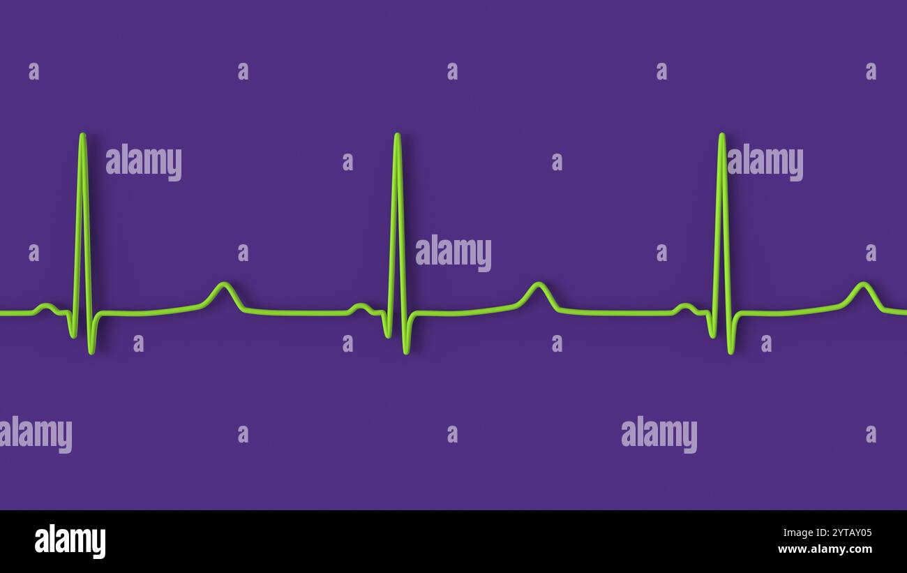 Illustration of an electrocardiogram (ECG) showing late onset T waves ...