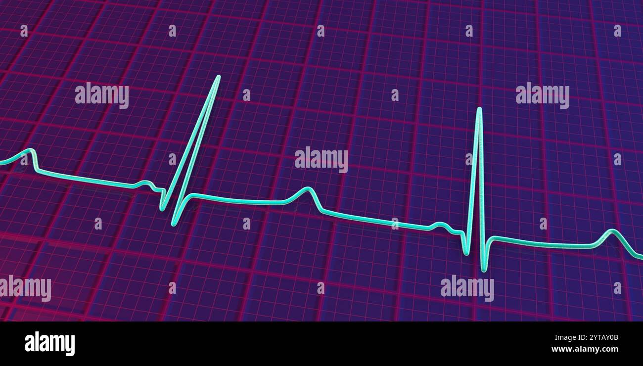 Illustration of an electrocardiogram (ECG) showing late onset T waves ...