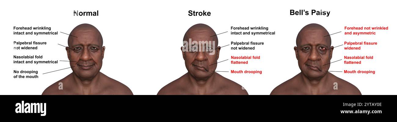 Computer illustration of a man showing left-side stroke (centre ...