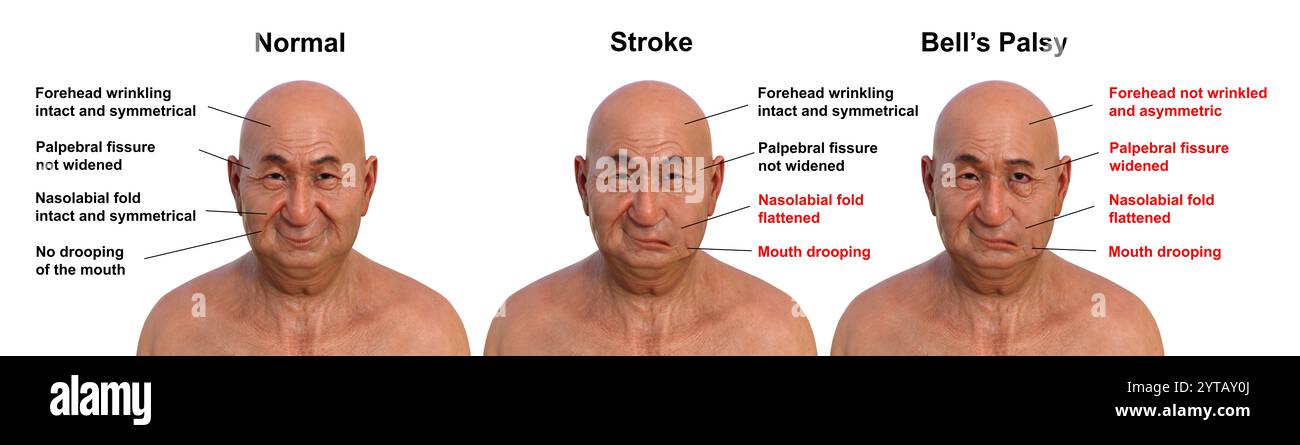 Computer illustration of a man showing left-side stroke (centre ...