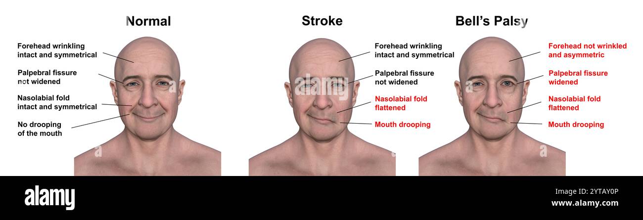 Computer illustration of a man showing left-side stroke (centre ...