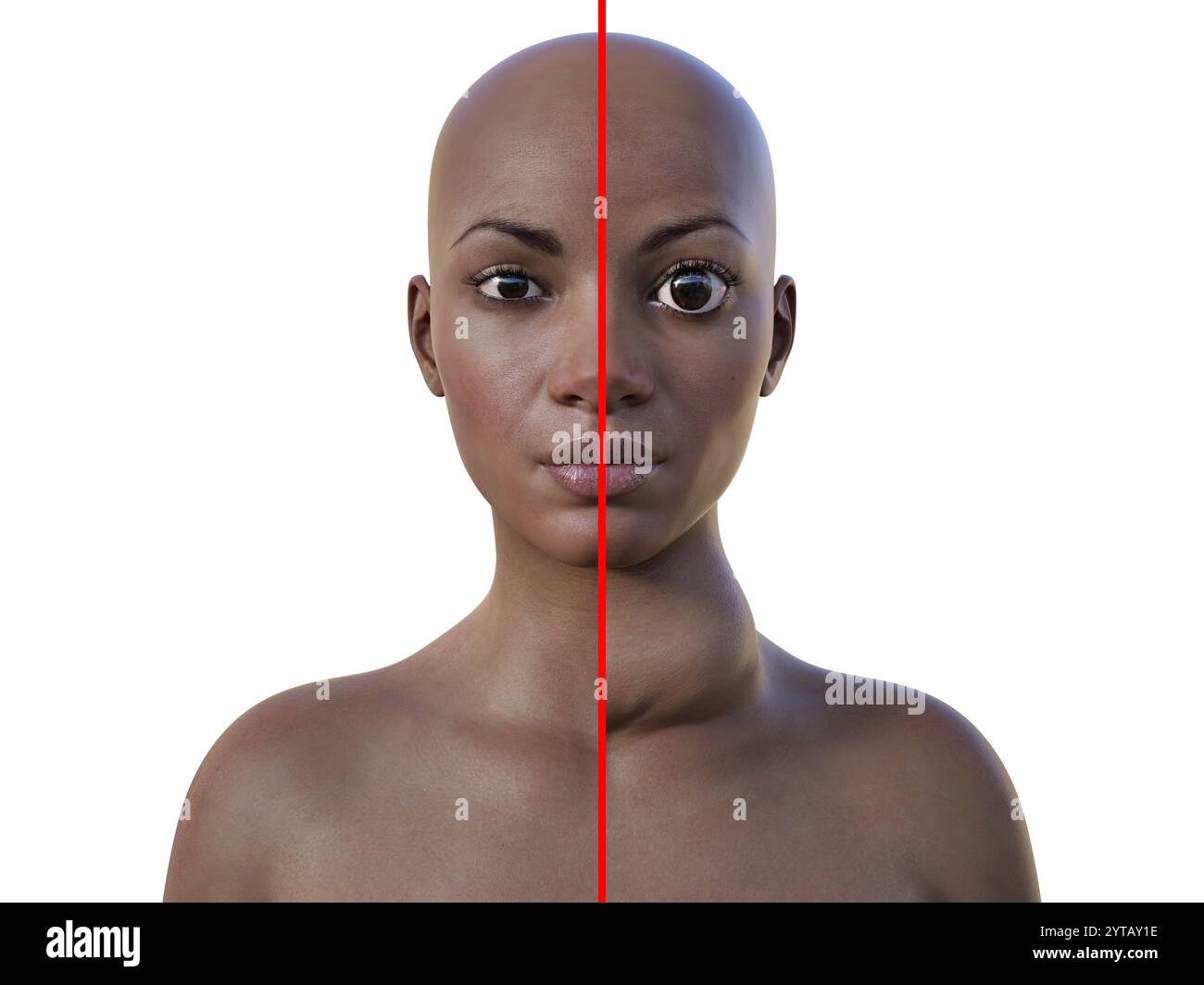 Woman with enlarged thyroid and exophthalmos hi-res stock photography ...