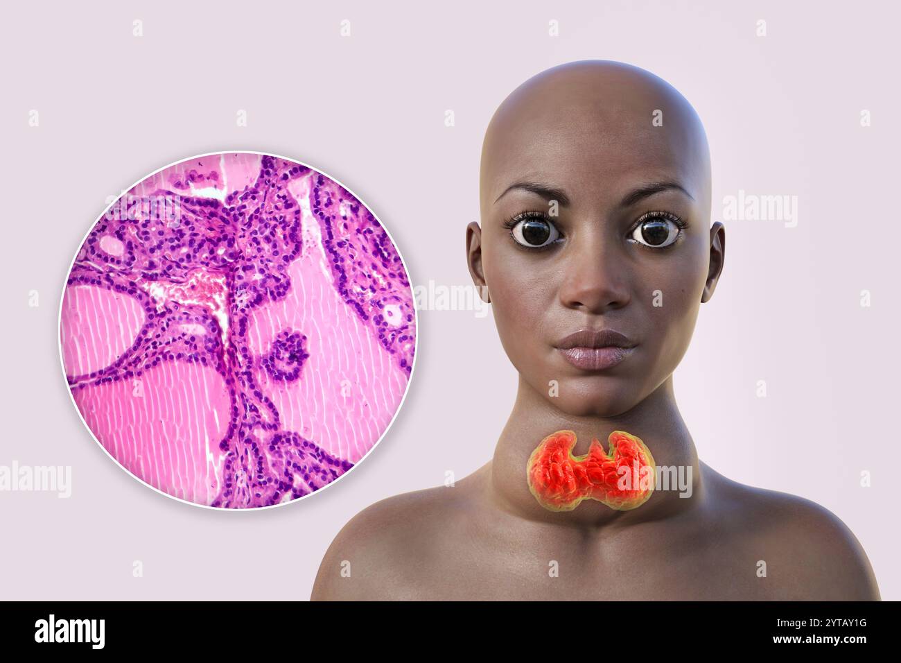 Computer illustration of a woman with an enlarged thyroid and ...