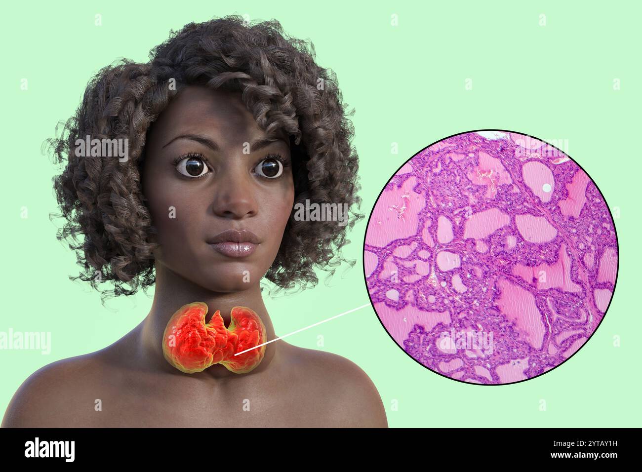 Computer illustration of a woman with an enlarged thyroid and ...