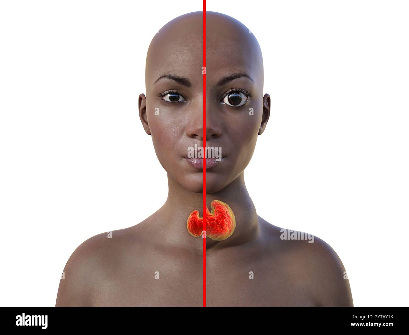 Computer illustration of a young woman's face and neck with transparent ...