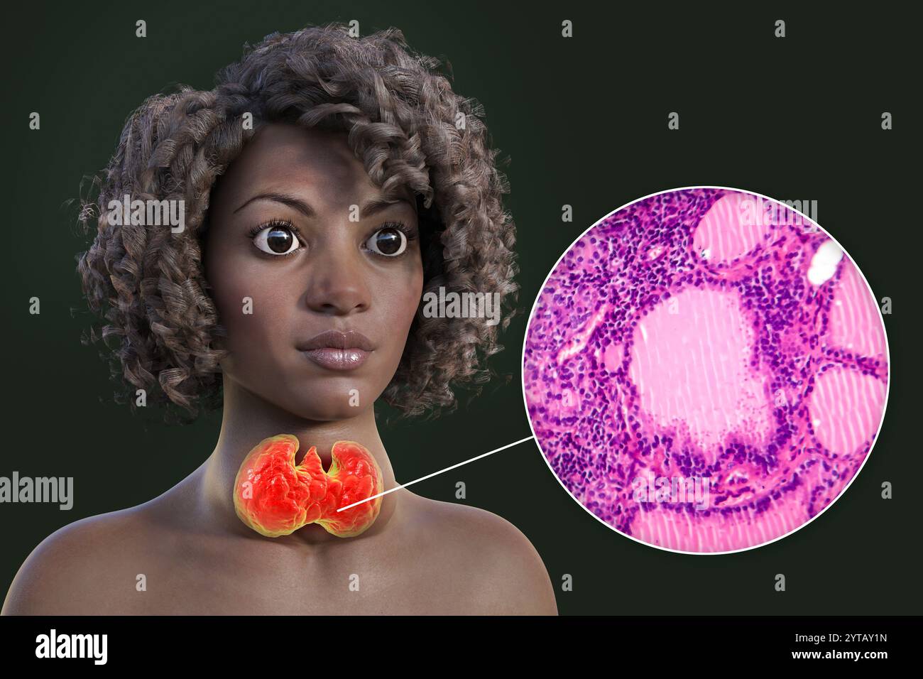 Computer illustration of a woman with an enlarged thyroid and ...
