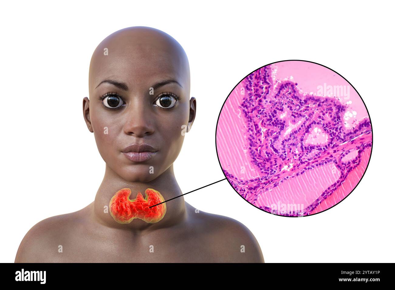 Computer illustration of a woman with an enlarged thyroid and ...