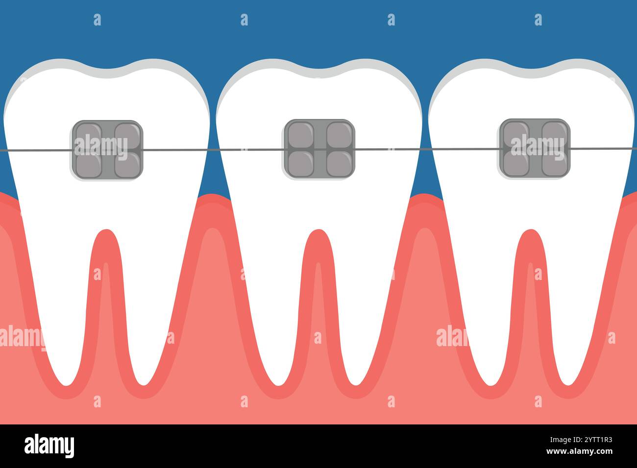 Vector illustration of teeth with braces Stock Vector Image & Art - Alamy