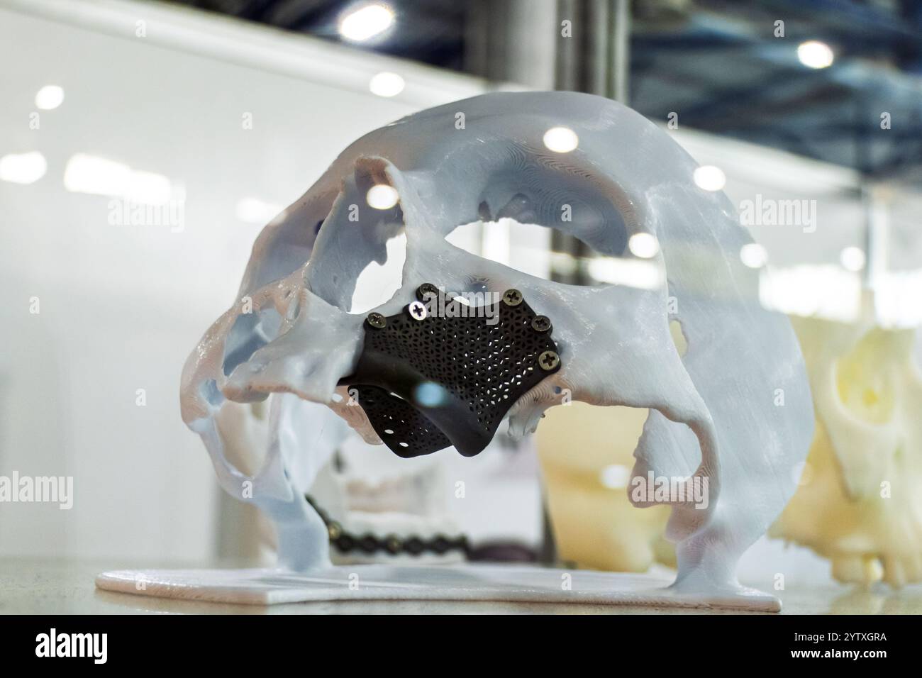 Orthopedic implants and individual titanium cranioplasties printed on a ...