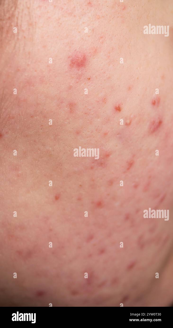 Many pimples. Bad skin. Hormonal acne, puberty. Skin acne background ...