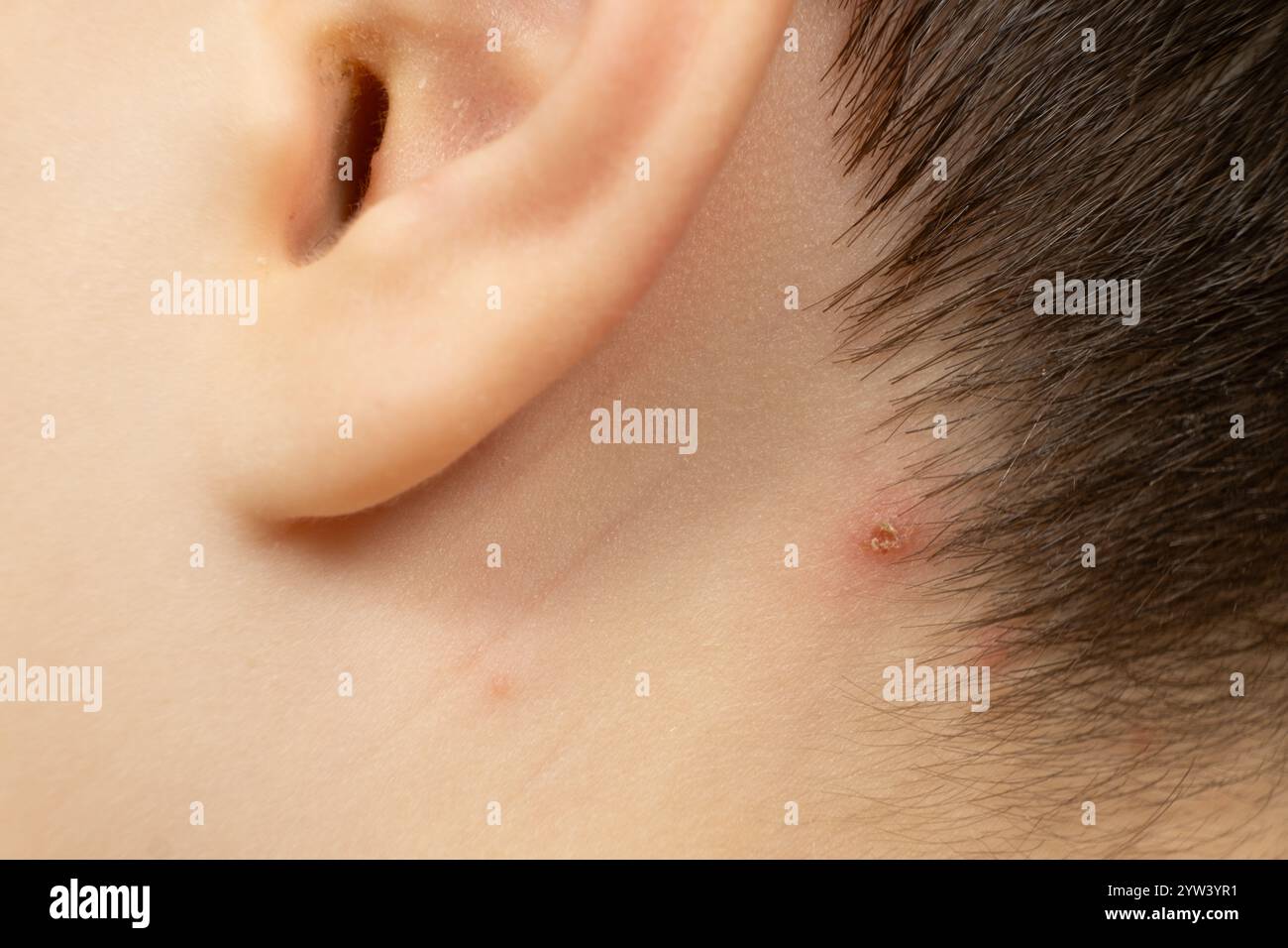 Macro skin with chickenpox, vesicles at different stages Stock Photo ...