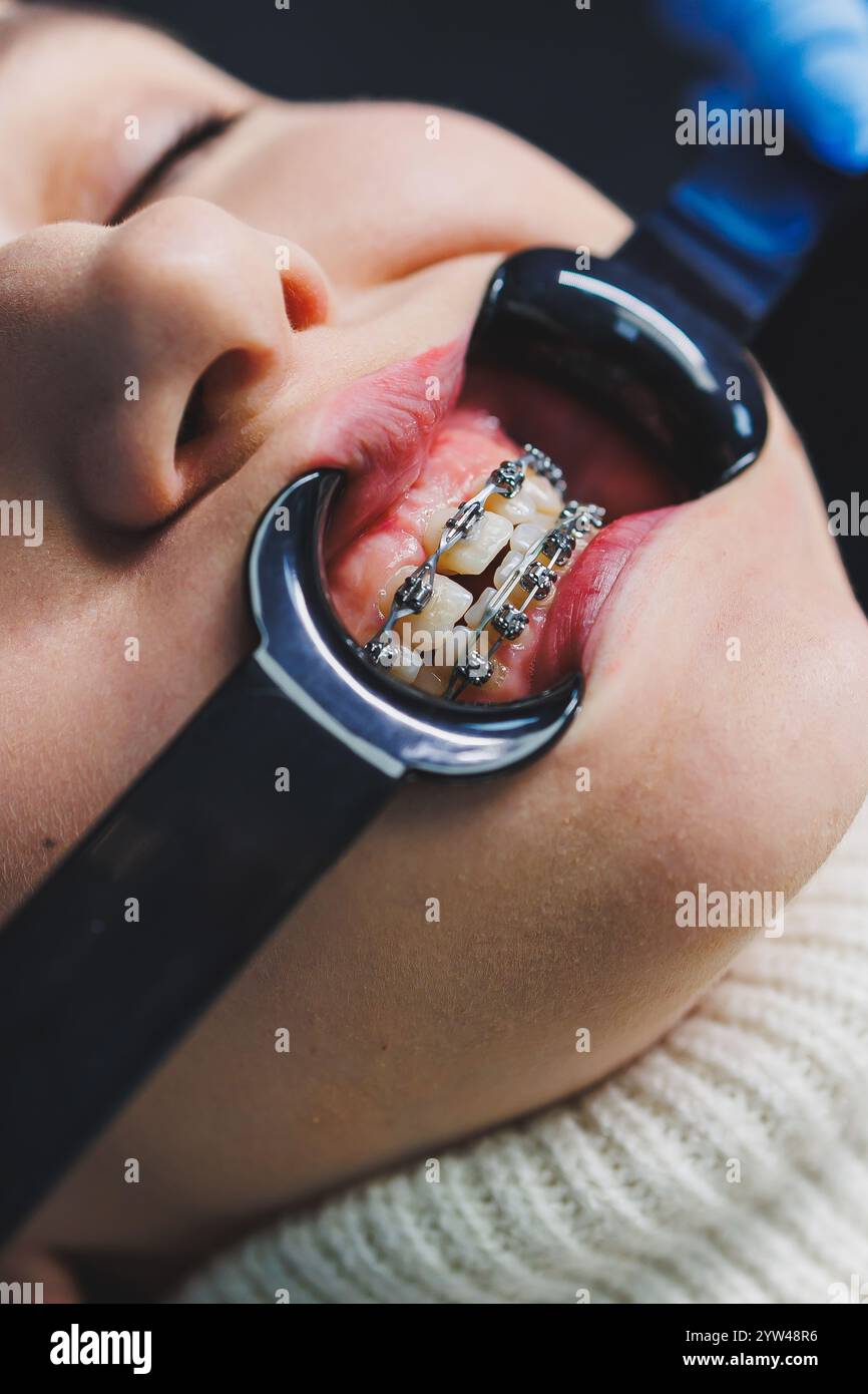 Oral care. Bracket system on women's teeth. Installation of braces to ...