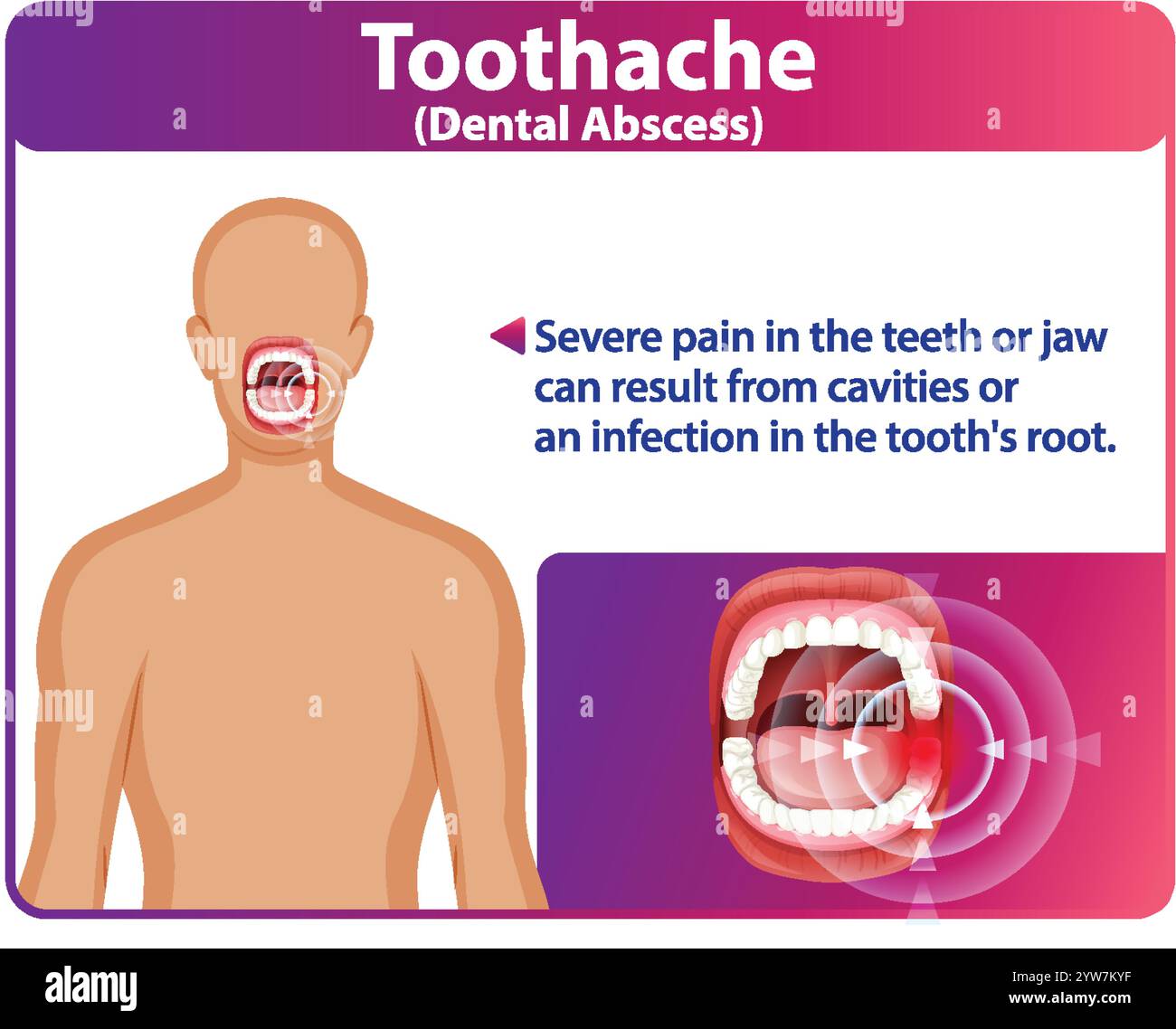 Illustration of toothache causes and symptoms Stock Vector Image & Art ...