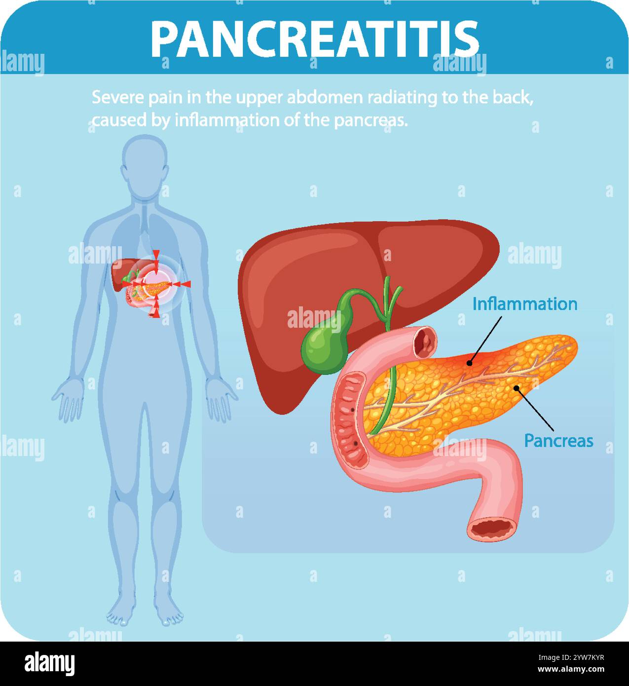 Illustration of pancreas inflammation and related pain Stock Vector ...
