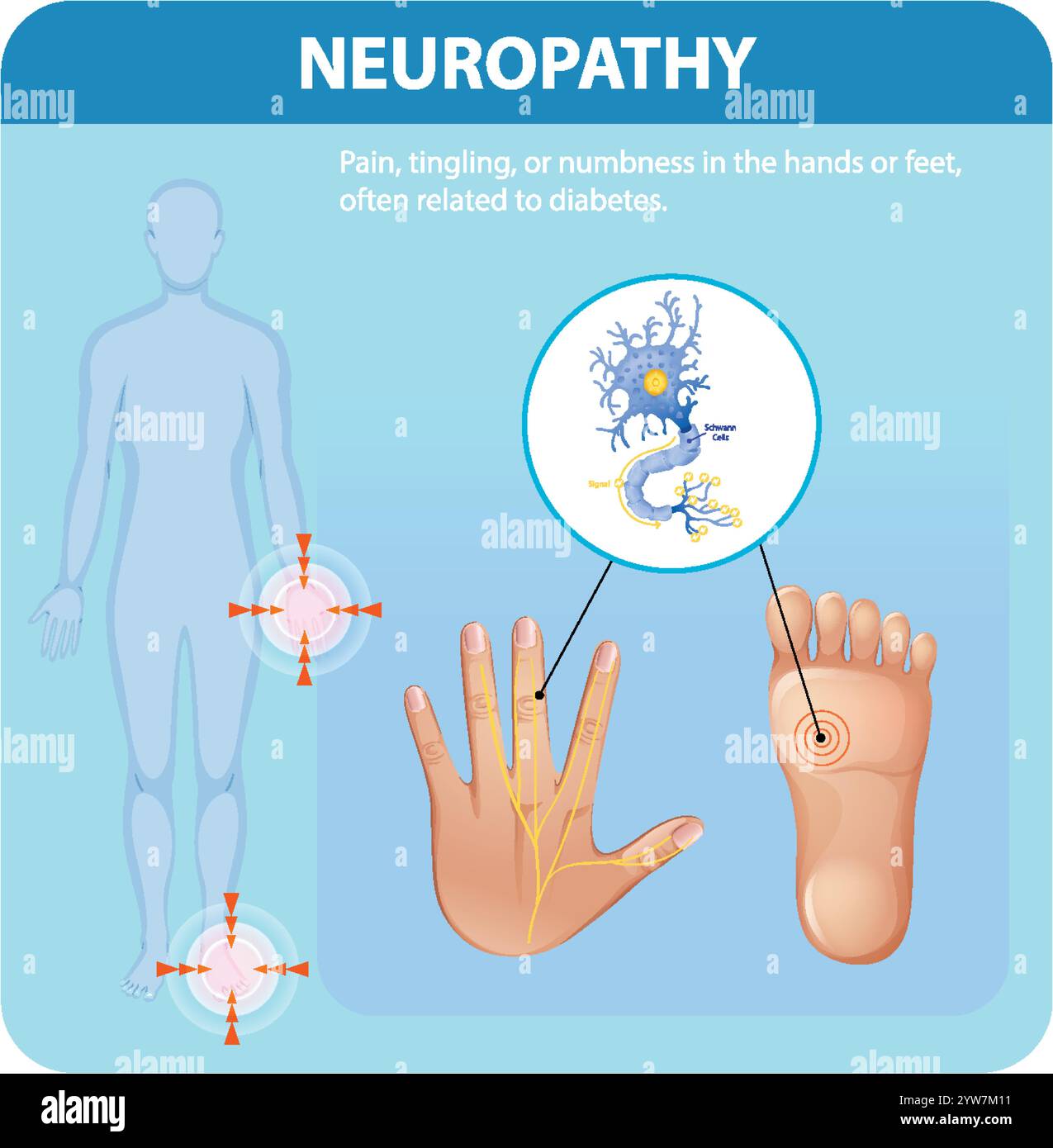 Illustration of neuropathy affecting hands and feet Stock Vector Image & Art - Alamy