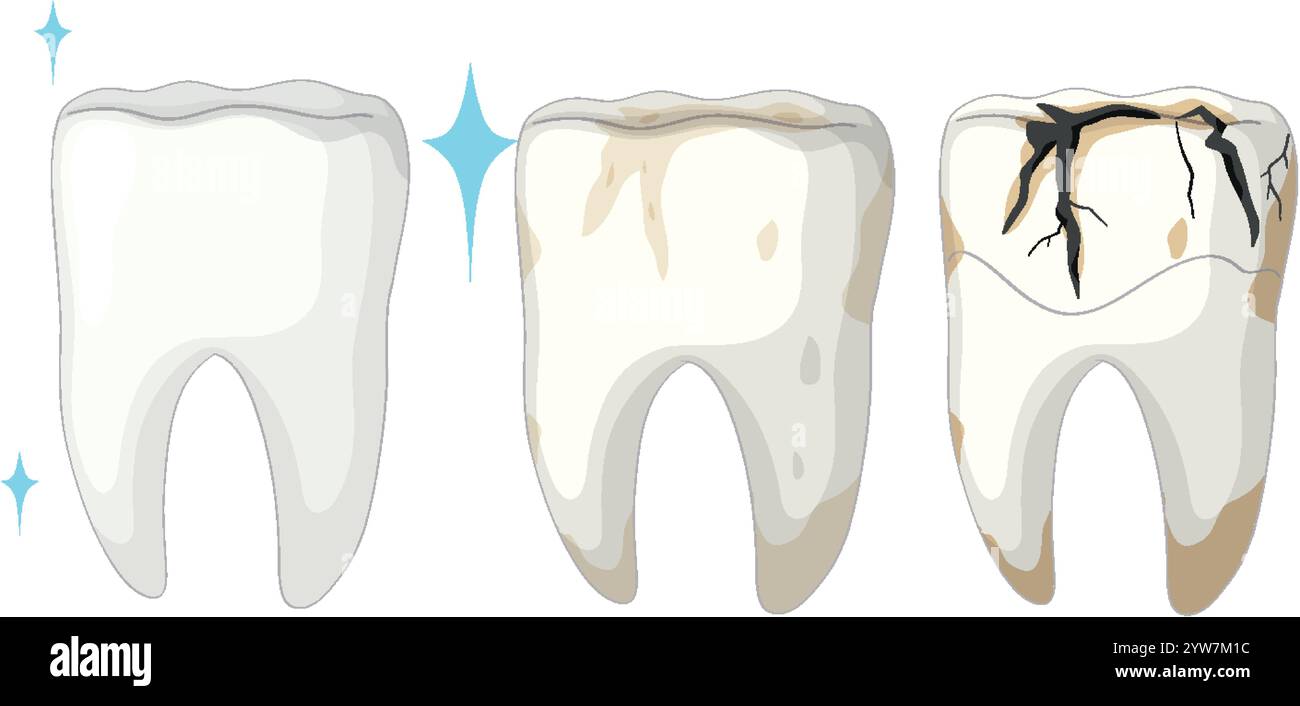 Illustration showing healthy, decaying, and damaged teeth Stock Vector ...