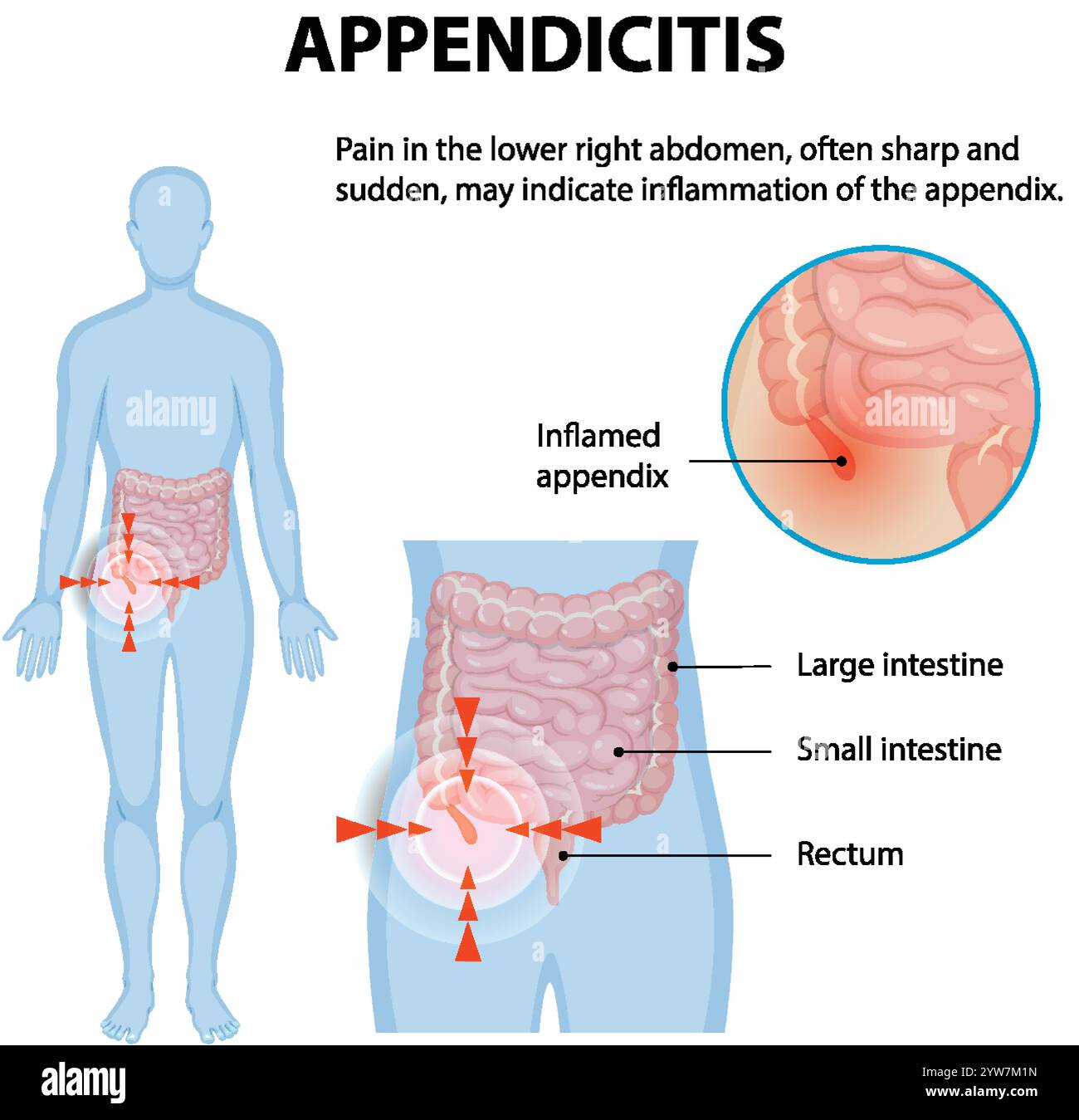 Illustration of inflamed appendix and abdominal pain Stock Vector Image & Art - Alamy
