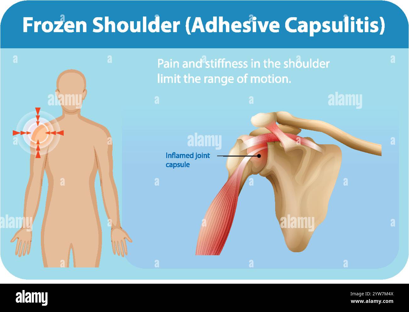 Illustration of shoulder pain and inflammation causes Stock Vector ...